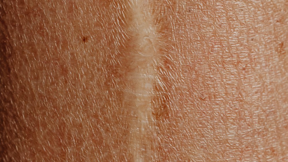 Entzündete Narbe: Ursachen, Symptome und effektive Behandlungsmethoden